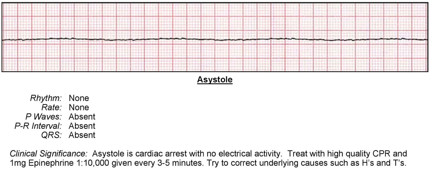Asystole Asystole