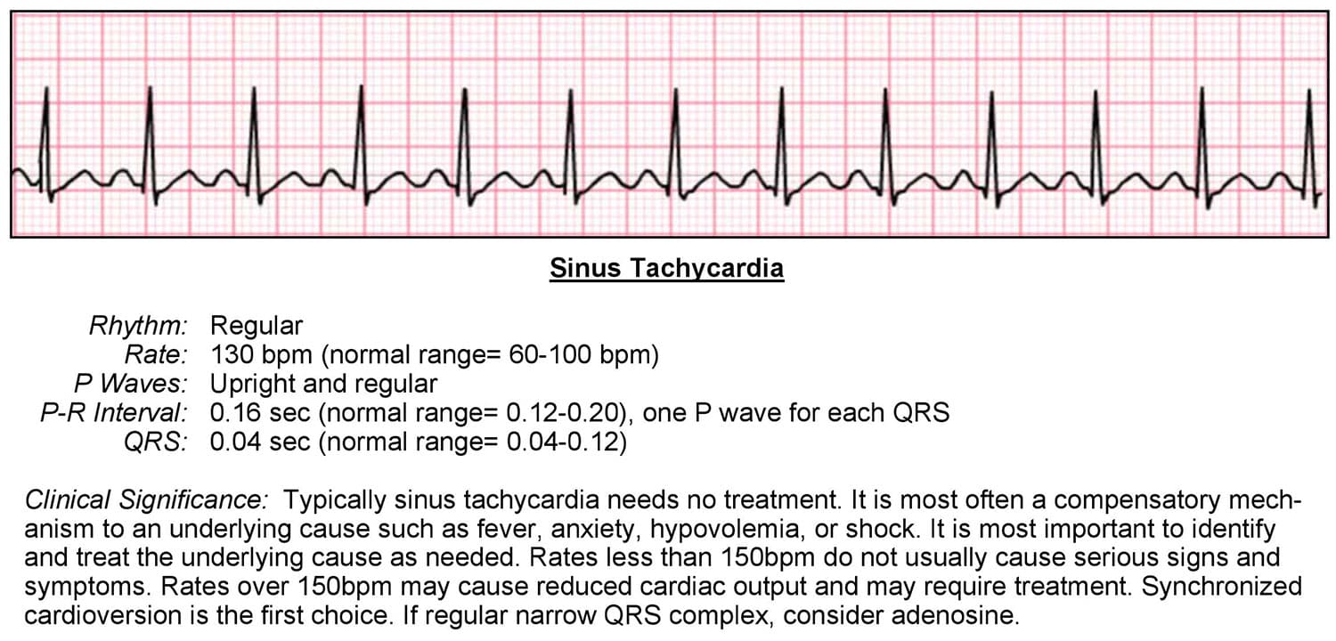 Tachycardia ACLS Wiki Tachycardia ACLS Wiki