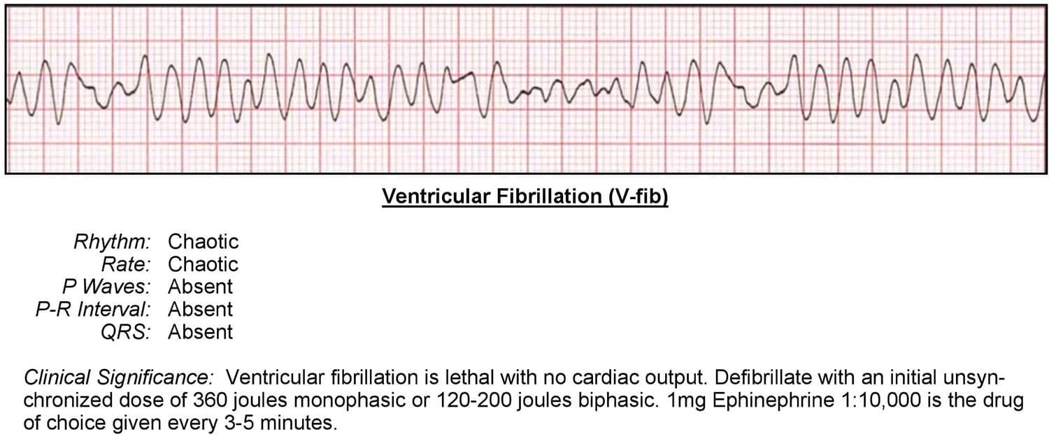 Ventricular Fibrillation